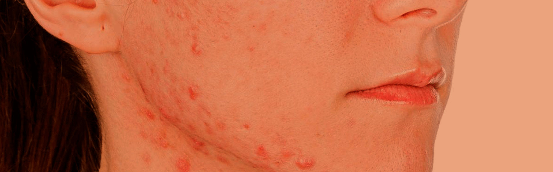 Acne | Clínica & Spa Palie Concept
